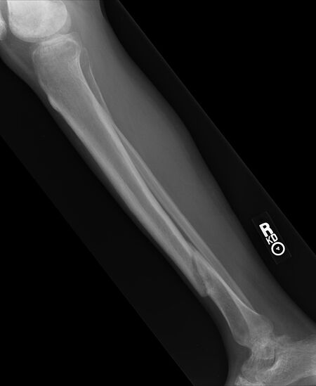 Knochenbrüche – KiwiThek